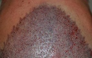 Steven Fletcher's Hair Transplant Result | Hair Loss Treatment