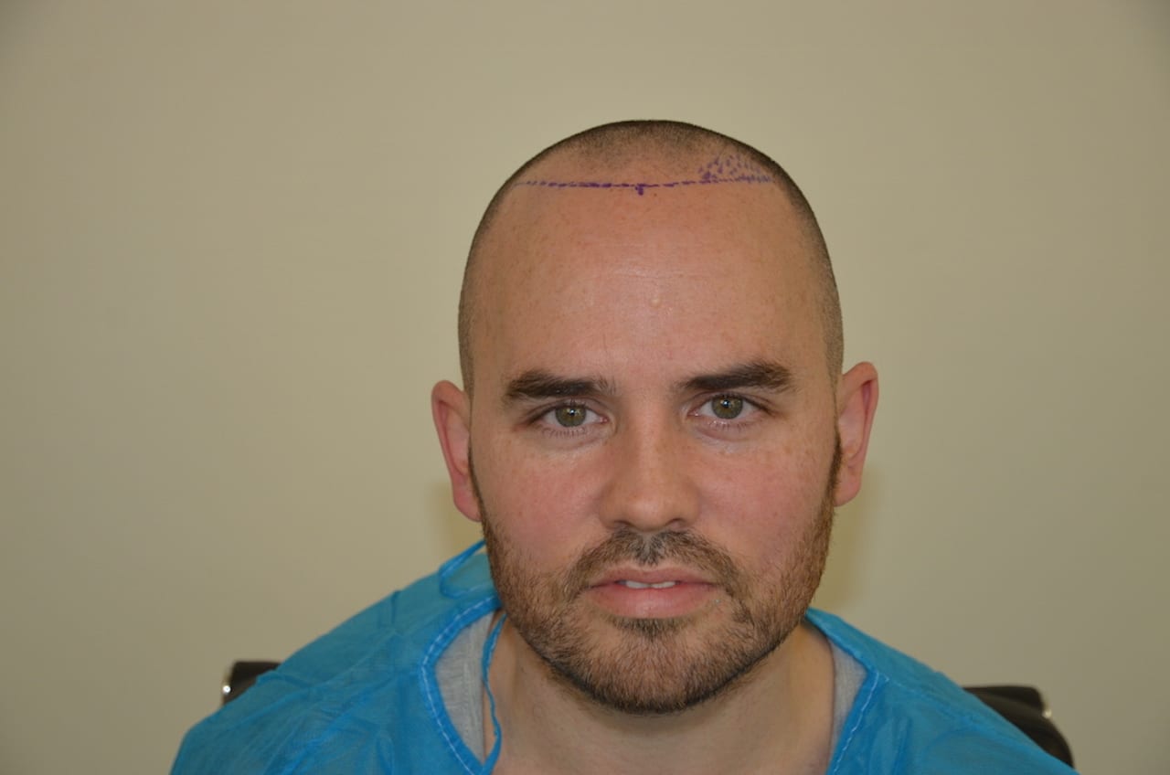 Patients Gallery Before & After - Harley Street Hair Clinic