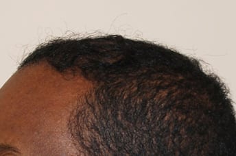 Patients Gallery Before & After - Harley Street Hair Clinic