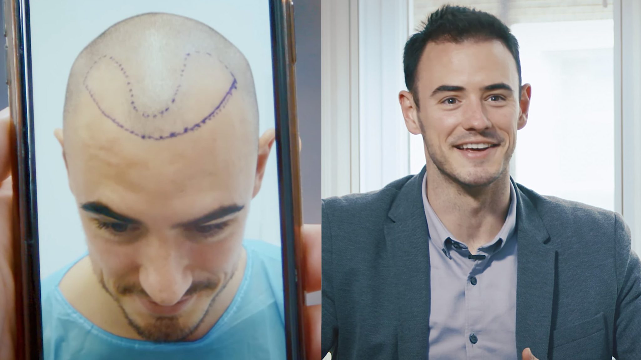 Hair Transplants UK: Hair Clinic In Harley Street - HS Hair