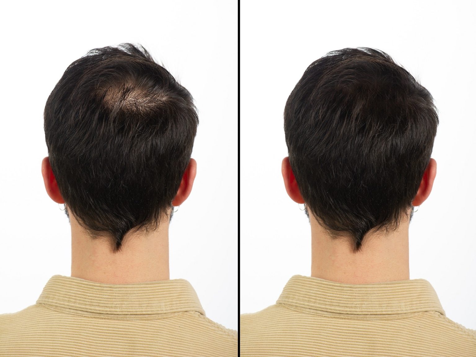 Crown Hair Loss & Crown Thinning: How to Prevent Hair Thinning