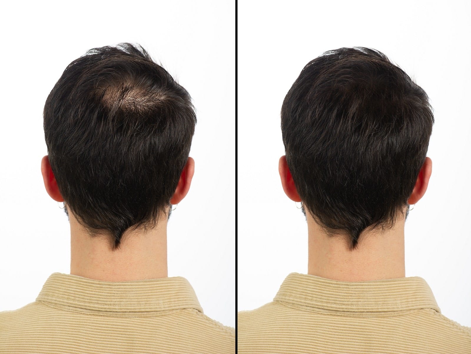 Crown Hair Loss & Crown Thinning: How to Prevent Hair Thinning
