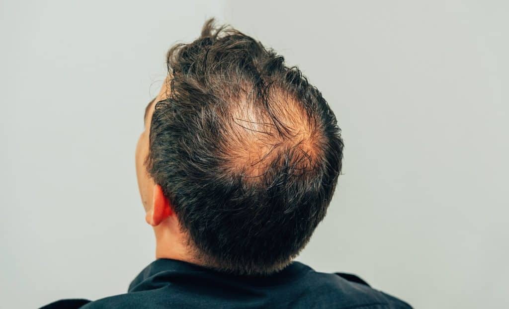 Crown Hair Loss & Crown Thinning: How to Prevent Hair Thinning