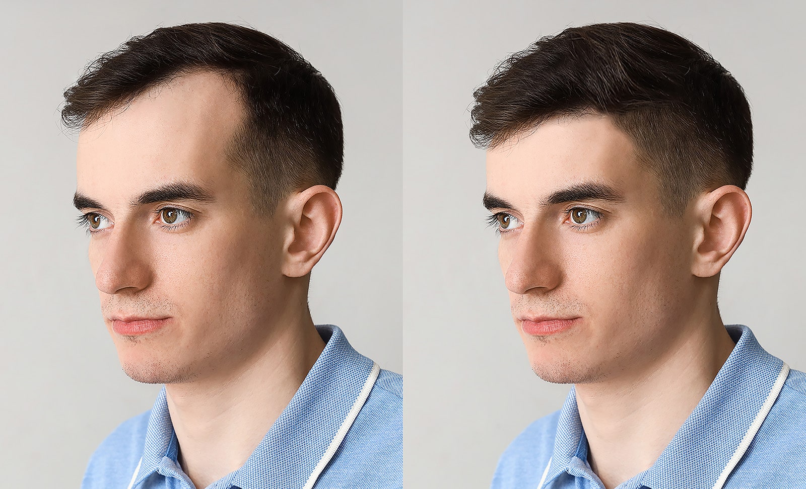 M-Shaped Hairlines: What's an M-Shaped Hairline?